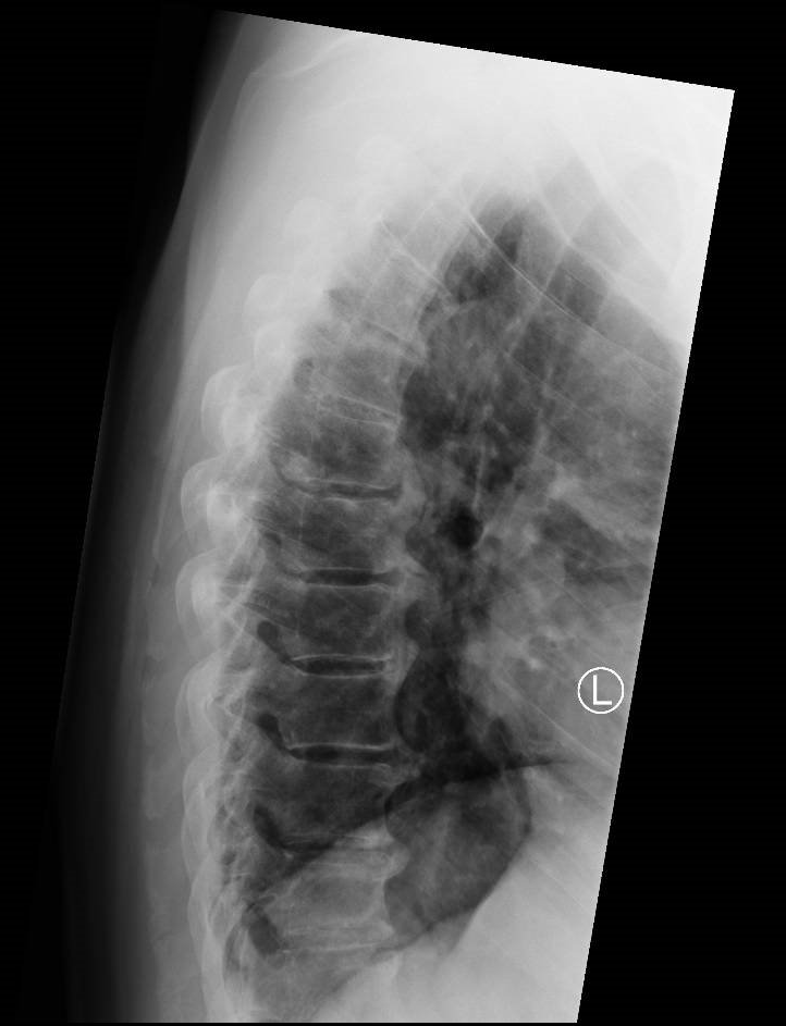Dissecting Lower Back Pain: Diffuse Idiopathic Skeletal Hyperostosis (DISH)